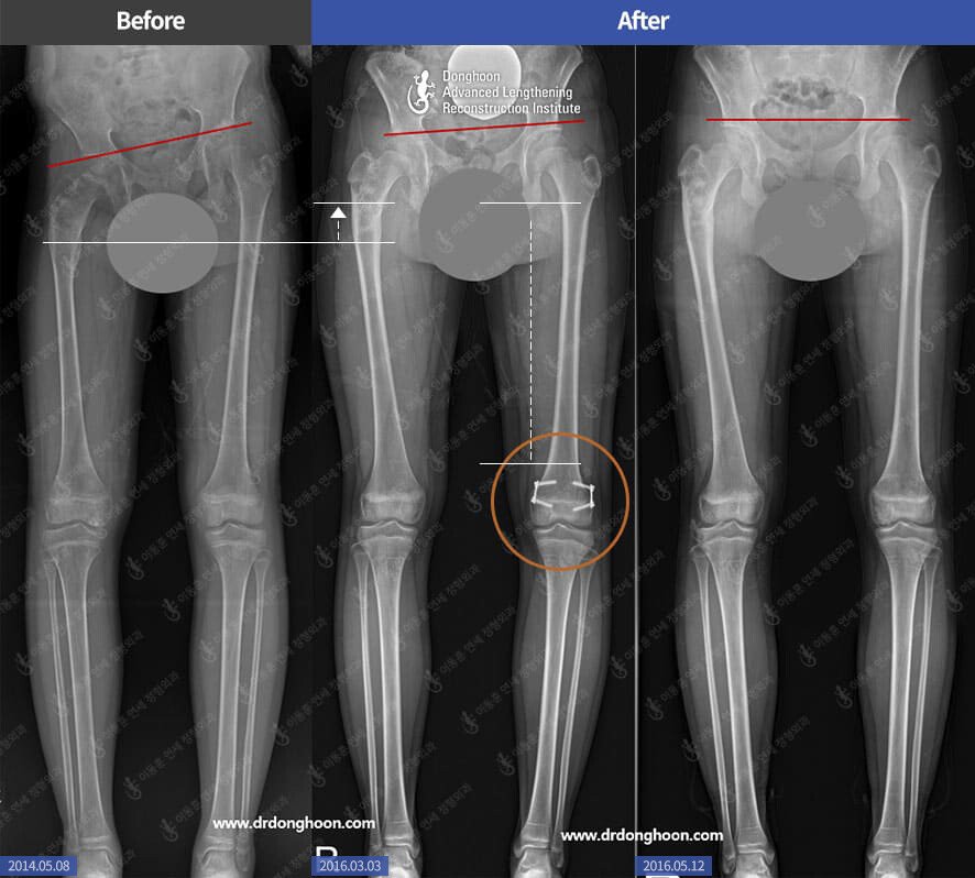 Leg Length Discrepancy Treatment Leg Length Discrepancy Treatment