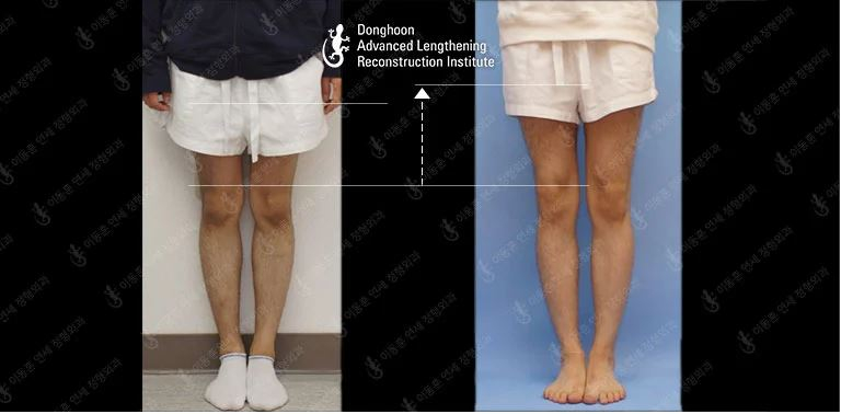 6cm of Femoral Lengthening by PRECICE – Limb Lengthening & Complex Reconstruction Service: Korea ...