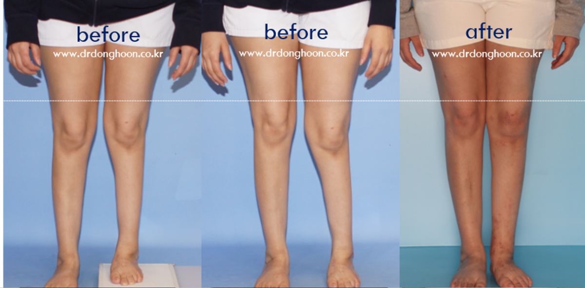 Post-Traumatic Leg Length Discrepancy (patient from UAE ) – Limb ...