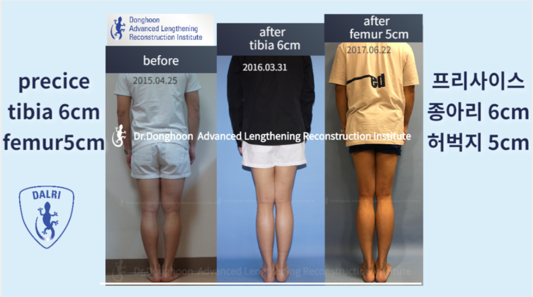6cm of Tibial Lengthening + 5cm Femoral Lengthening by PRECICE – Limb Lengthening & Complex ...